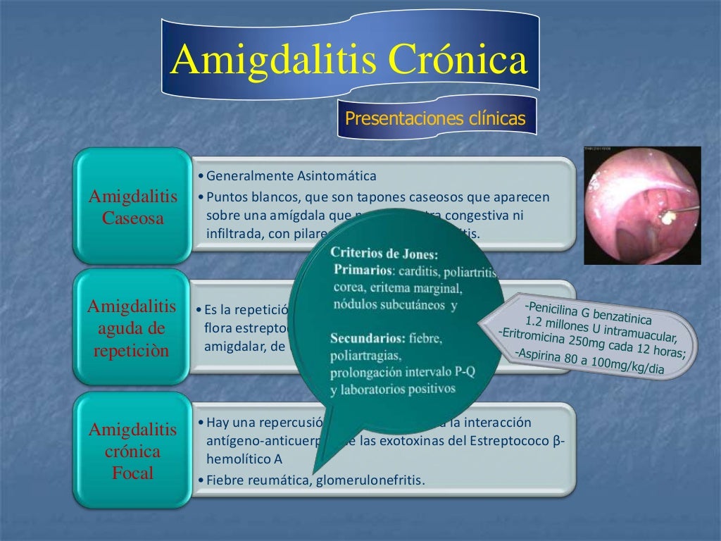 Amigdalitis crónica