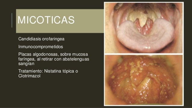 Amigdalitis y complicaciones