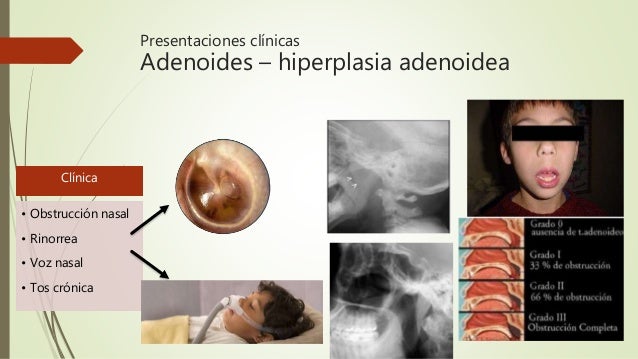 Adenoamigdalitis y complicaciones