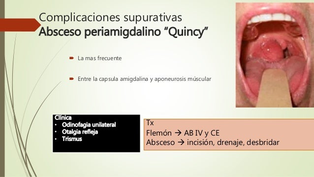 Adenoamigdalitis y complicaciones