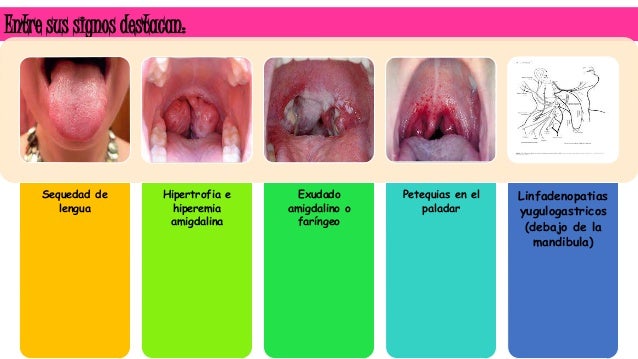 Amigdalitis y laringotraqueitis nelly valle morales