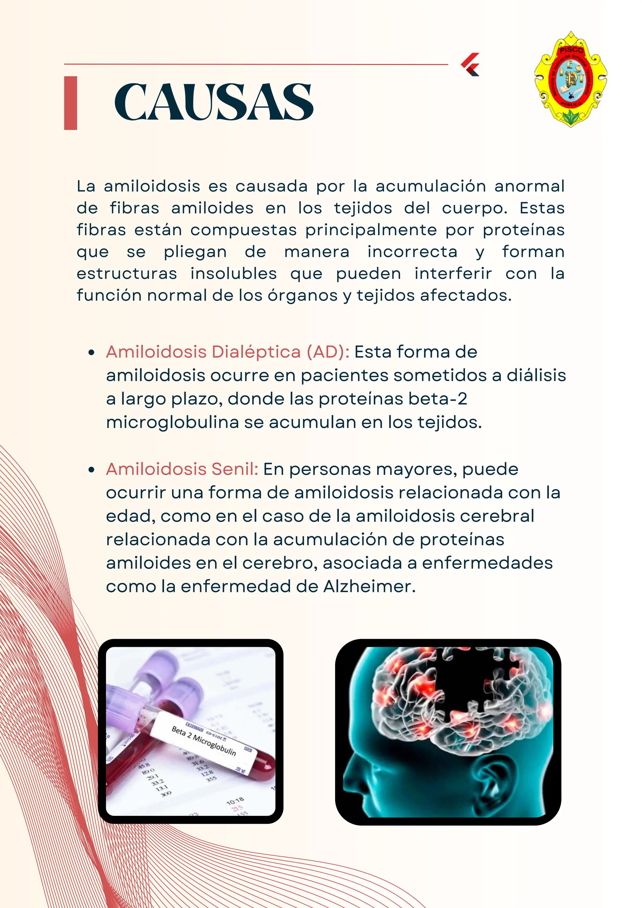 ENFERMEDAD AMILOIDOSIS INTITUTO SUPERIOR TECNOLOGICO PISCO | PDF