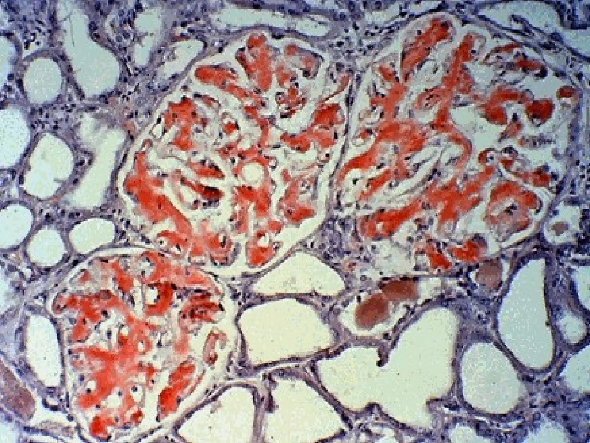 Amiloidoz (fazlası için www.tipfakultesi.org ) | PPT