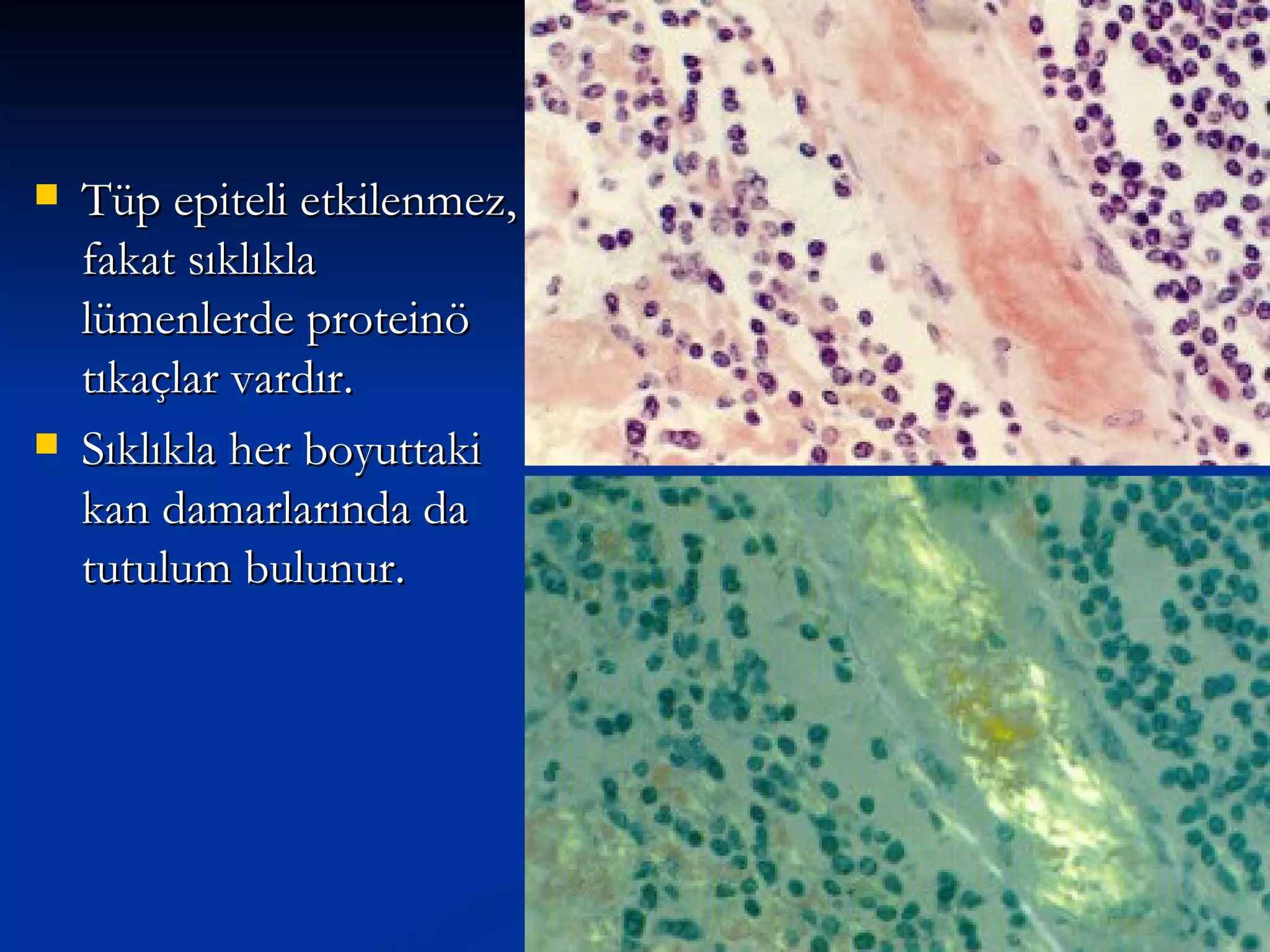 Amiloidoz (fazlası için www.tipfakultesi.org ) | PPT