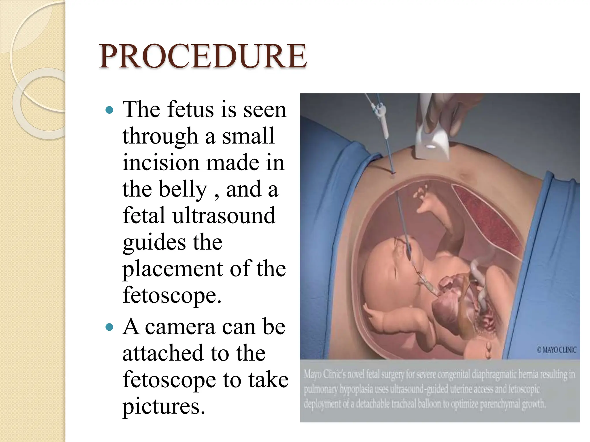AMINOSCOPY AND FETOSCOPY INVASIVE PROCEDURE.pptx