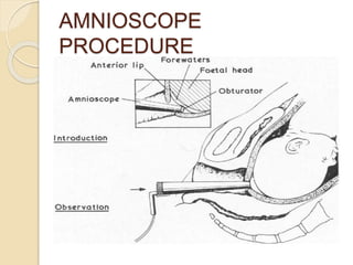 AMINOSCOPY AND FETOSCOPY INVASIVE PROCEDURE.pptx
