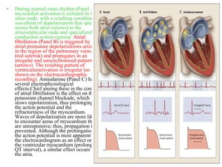 Amiodarone | PPS