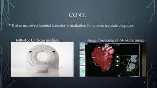 Recent Avancement of CT Scan | PPTX