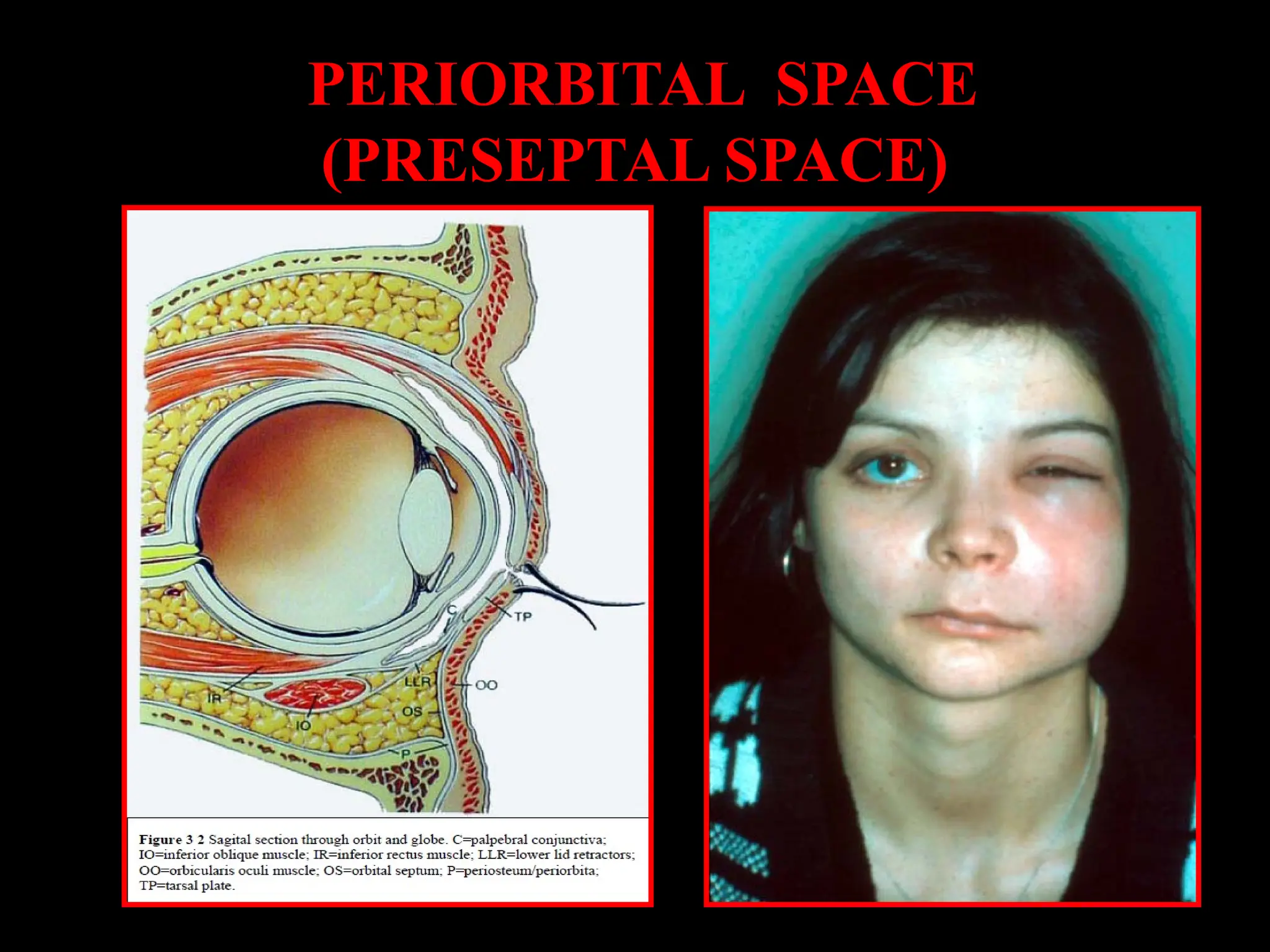 space infection in oral [Autosaved].pptx