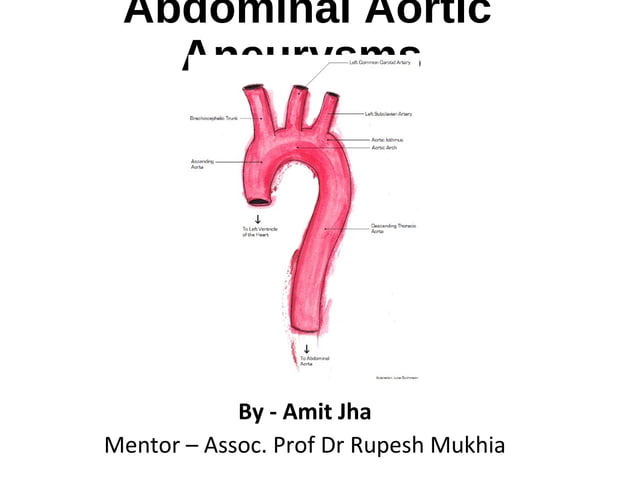 Abdominal Aortic Aneurysms | PPT | Digestive Disorders | Diseases and Conditions