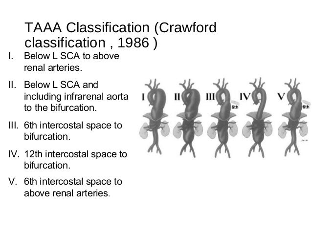 Abdominal Aortic Aneurysms