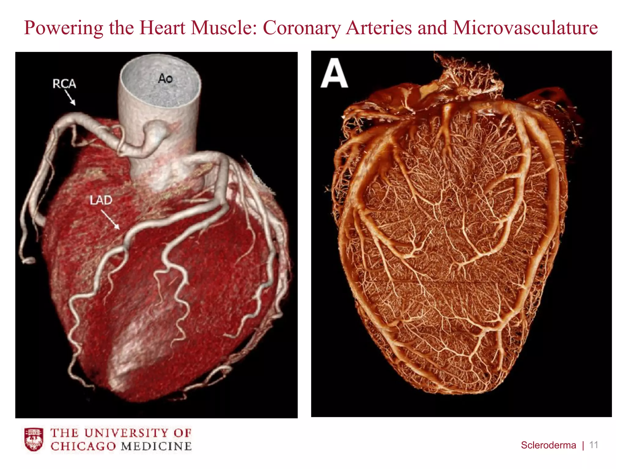 Normal Heart Function and Changes that can Occur in Scleroderma | PDF