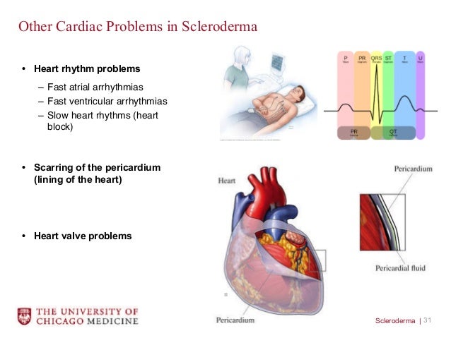 Normal Heart Function and Changes that can Occur in Scleroderma