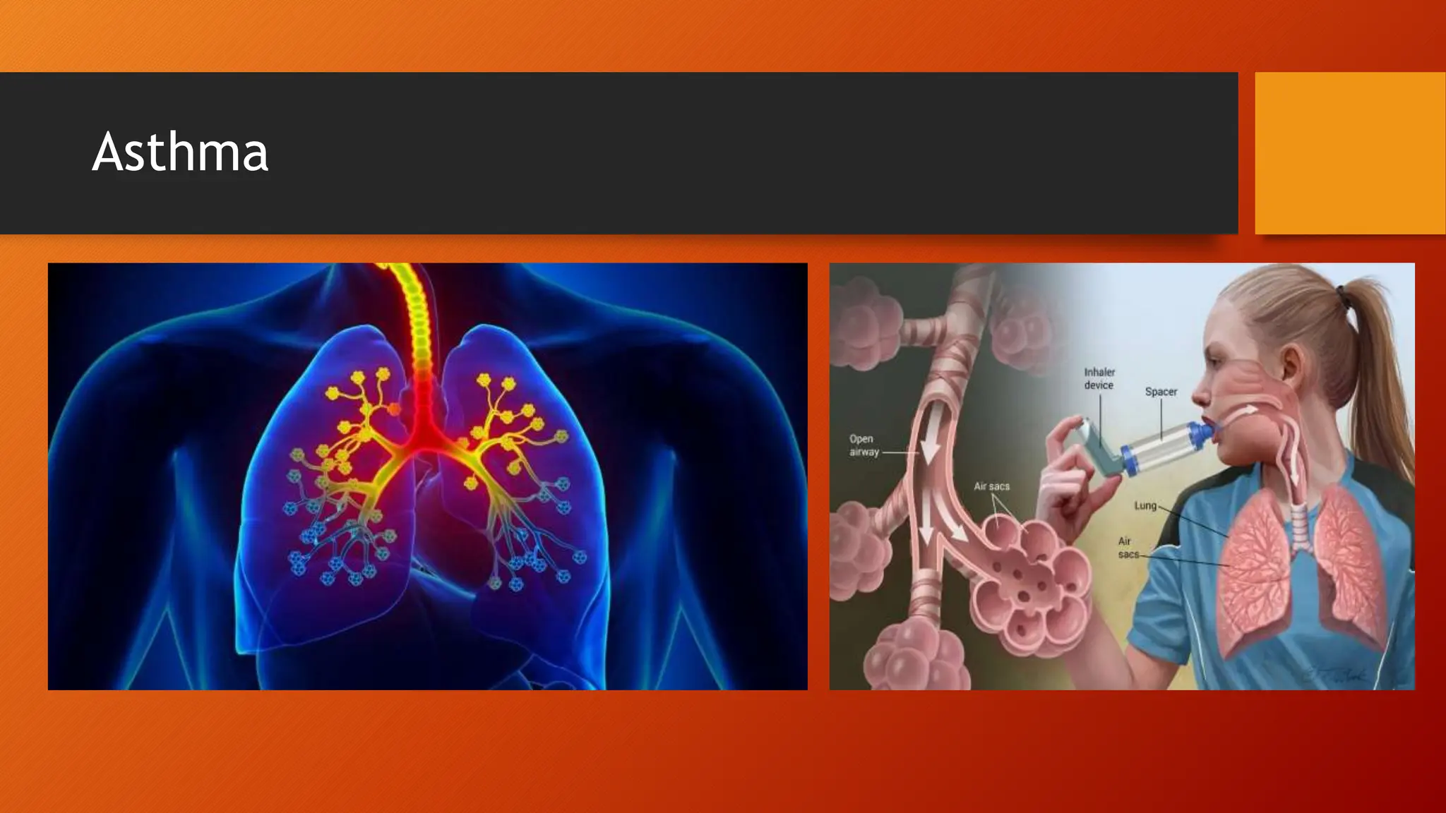 amit yadav topic athma. & Classification of asthma pptx | PPTX | Lung and Respiratory Health ...