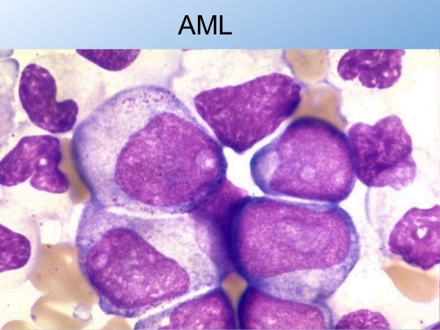 Acute myeloid leukemia