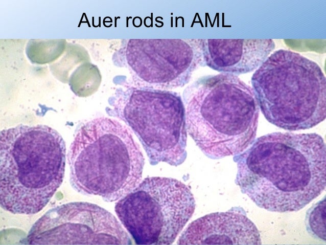 Acute myeloid leukemia