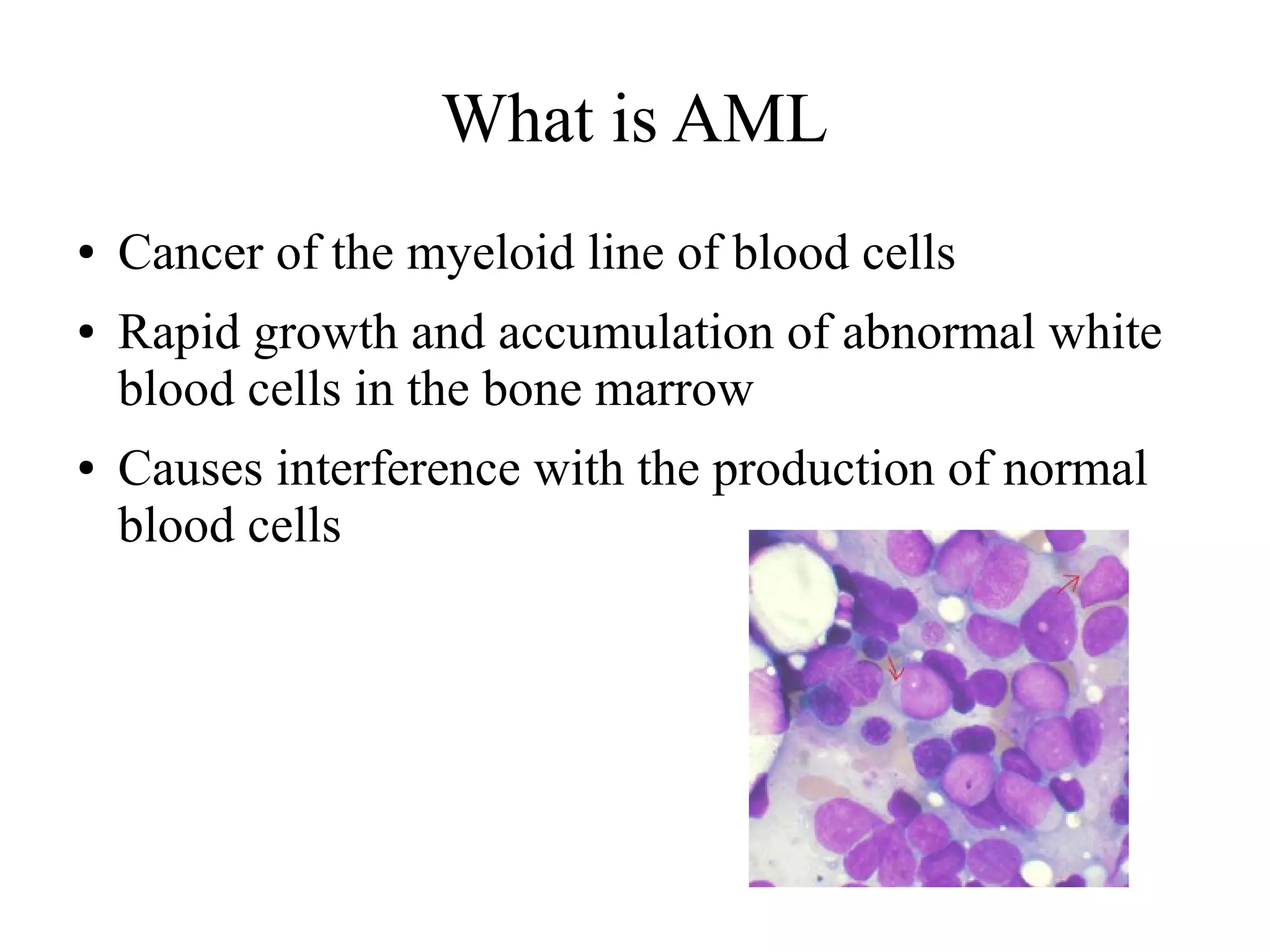 Acute Myeloid Leukemia | ODP