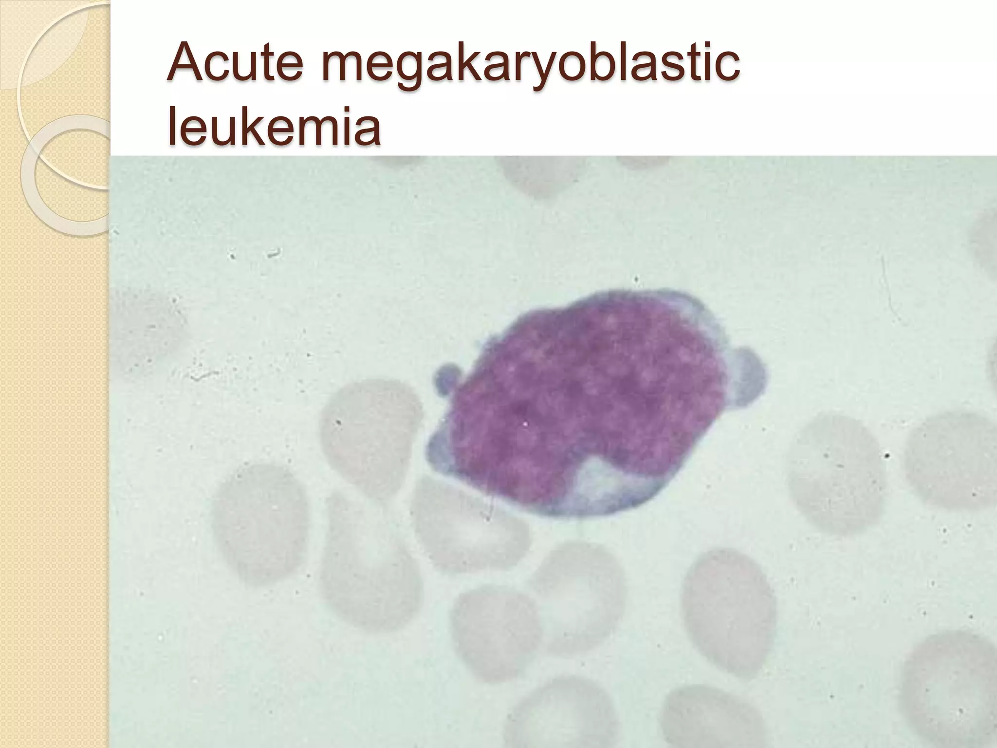 Acute myeloid leukemia | PPTX