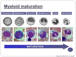 acute myeloid luekemia: Dr Arun Haldia | PPTX