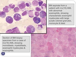 acute myeloid luekemia: Dr Arun Haldia | PPTX