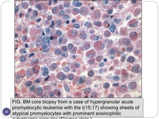 acute myeloid luekemia: Dr Arun Haldia | PPTX