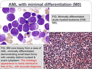 acute myeloid luekemia: Dr Arun Haldia | PPTX