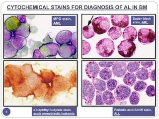 acute myeloid luekemia: Dr Arun Haldia | PPTX