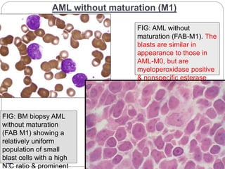 acute myeloid luekemia: Dr Arun Haldia | PPTX