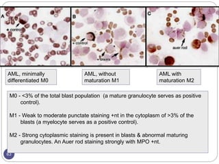 acute myeloid luekemia: Dr Arun Haldia | PPTX