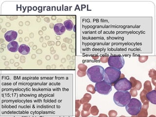 Acute Promyelocytic Leukemia Microgranular Variant