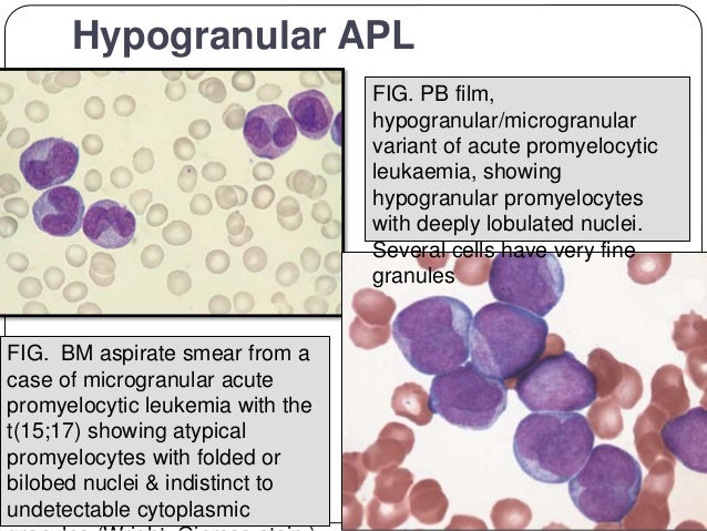 acute myeloid luekemia: Dr Arun Haldia