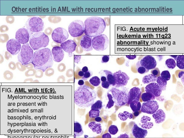 acute myeloid luekemia: Dr Arun Haldia