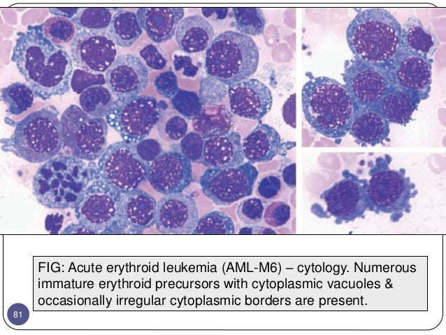 Acute Myeloid Leukemia Stages