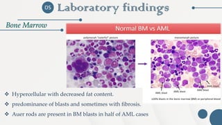 Hematologic Malignancies : Acute myeloid leukemia (AML).pdf