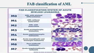 Hematologic Malignancies : Acute myeloid leukemia (AML).pdf