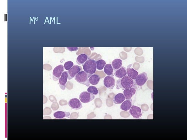 leukemia: Aml and all by asif | PPT