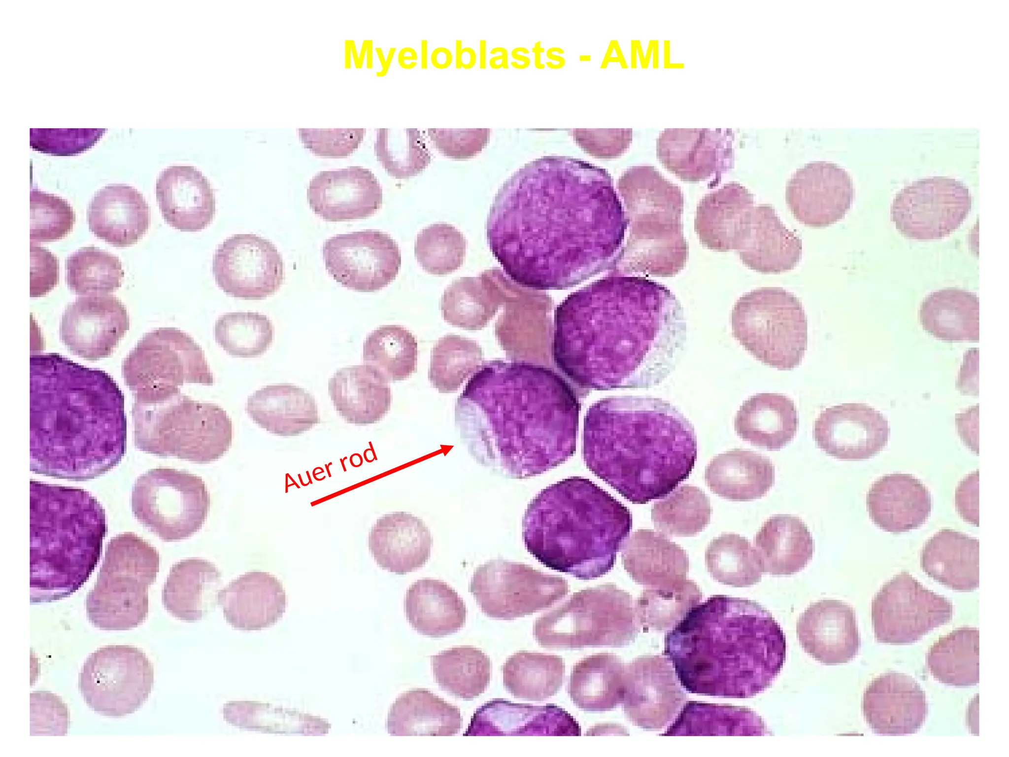 Acute Myeloid Leukemia Classification.pptx