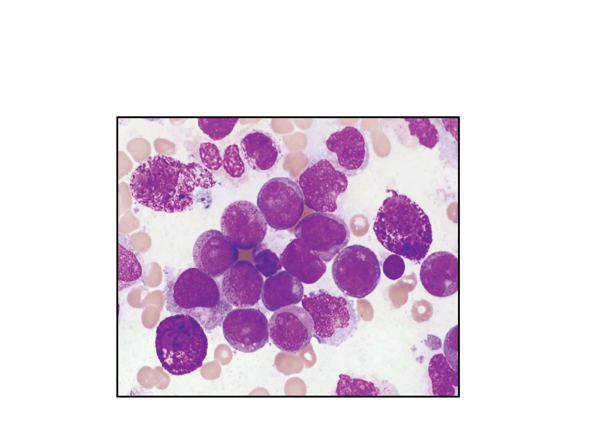 Acute Myeloid Leukemia Classification.pptx