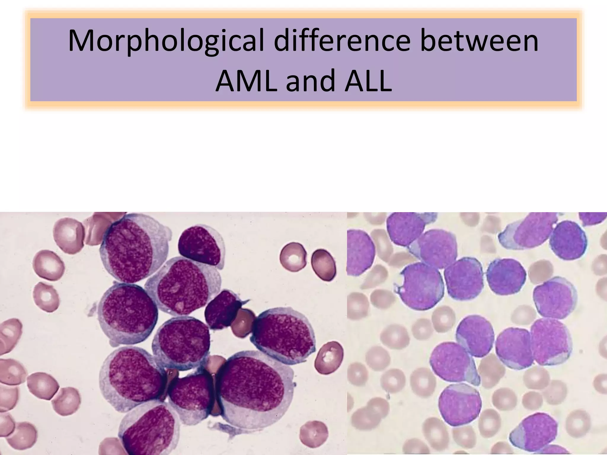 Acute Leukemia Cytogenetics | PPTX