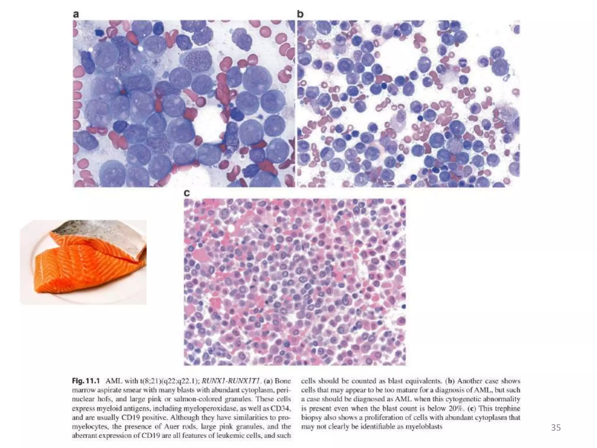 Acute Leukemia Cytogenetics | PPTX