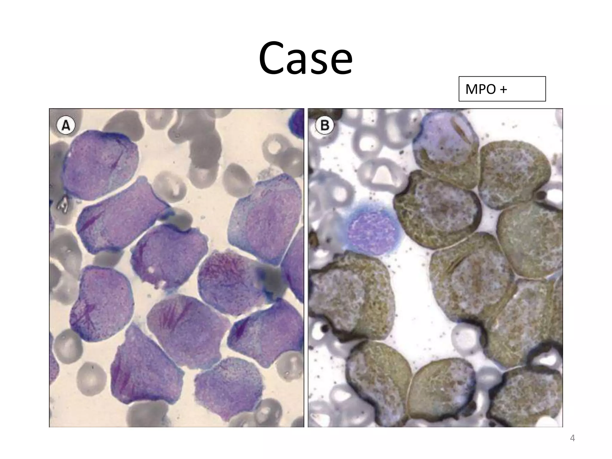 Acute Leukemia Cytogenetics | PPTX