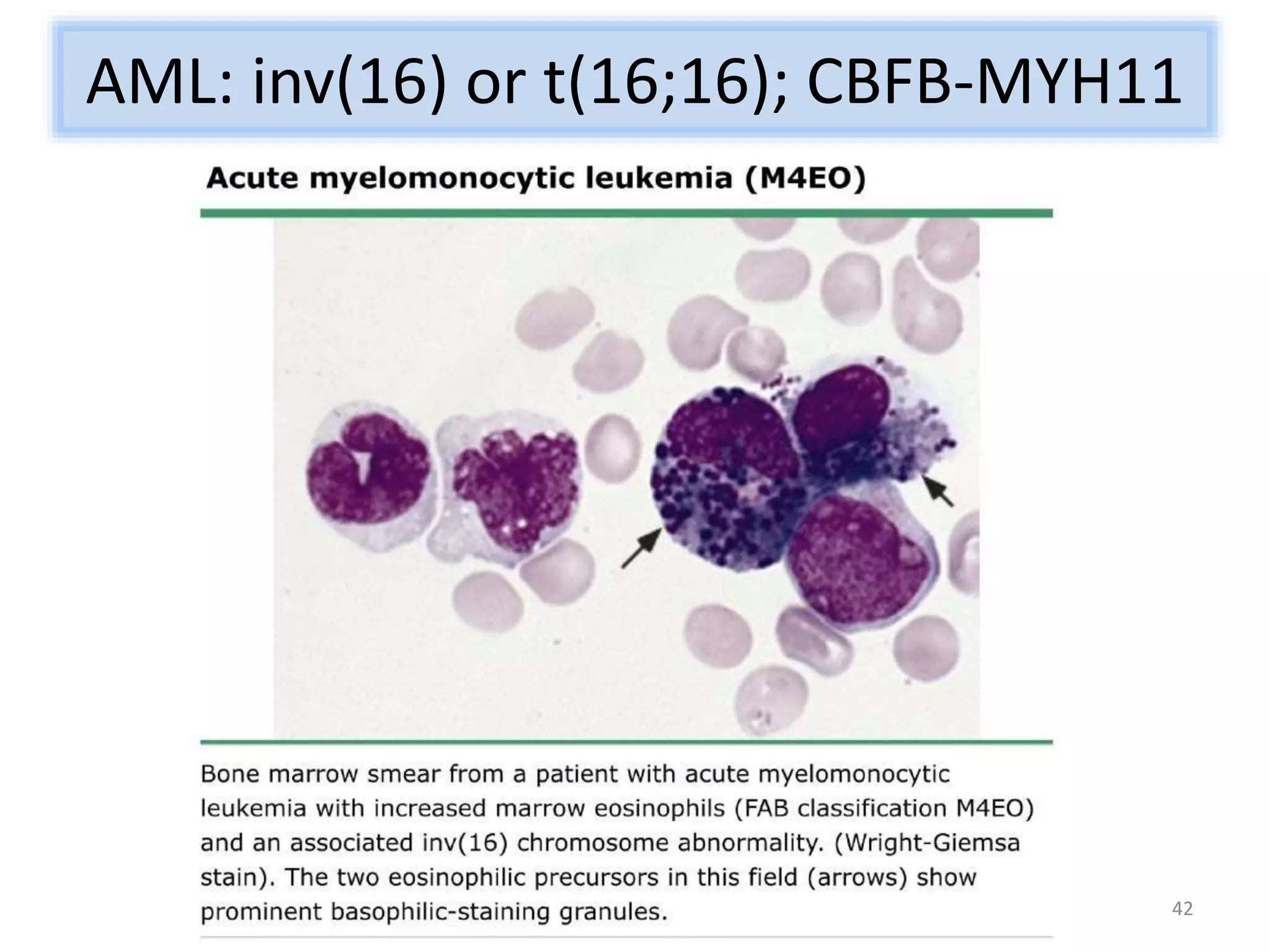 Acute Leukemia Cytogenetics | PPTX