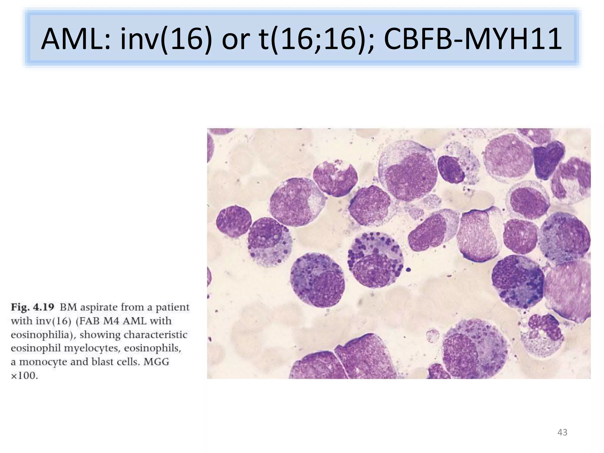 Acute Leukemia Cytogenetics | PPTX
