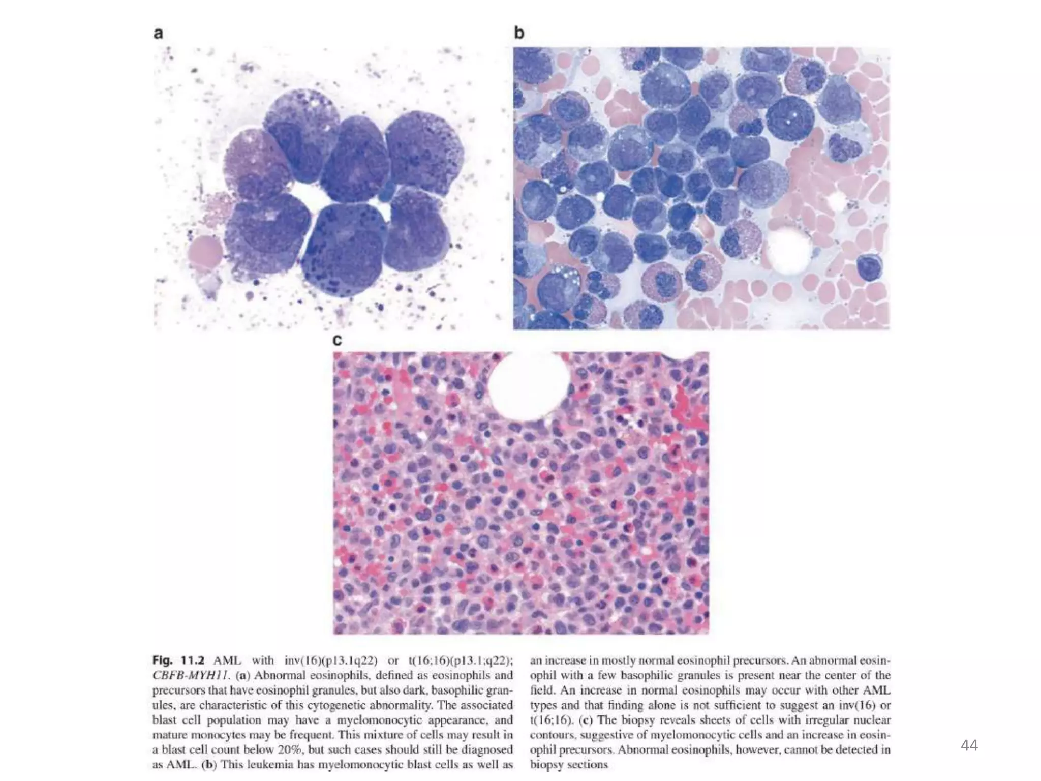Acute Leukemia Cytogenetics | PPTX