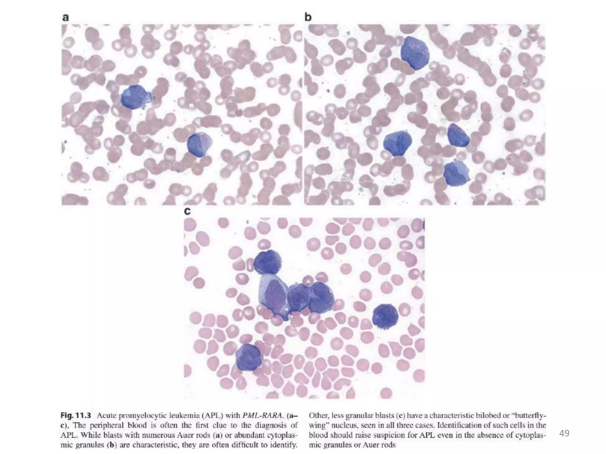 Acute Leukemia Cytogenetics | PPT