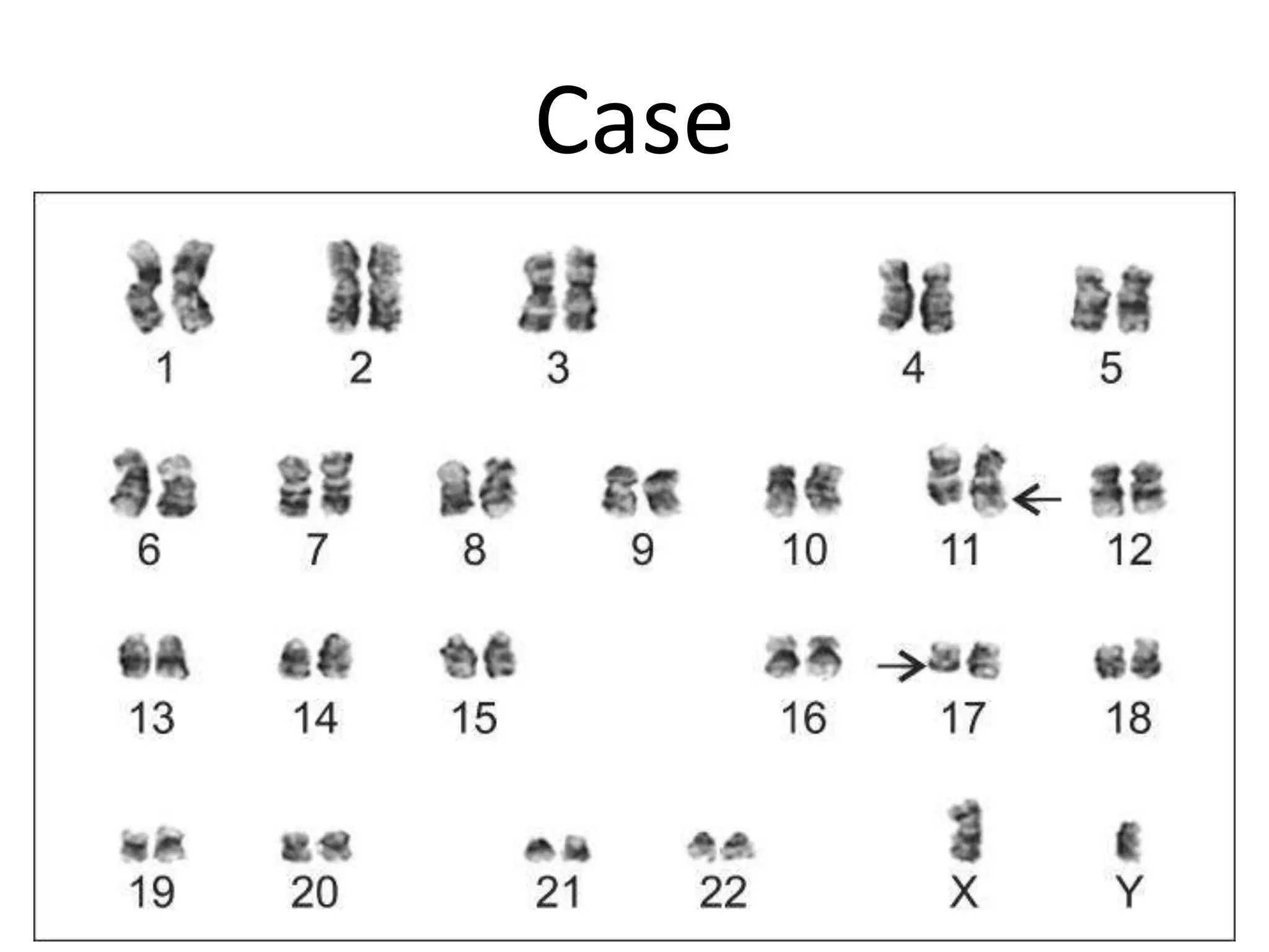 Acute Leukemia Cytogenetics | PPTX