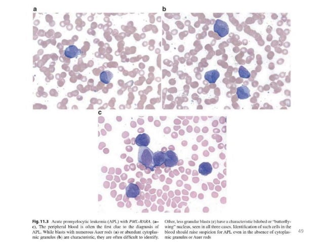 Acute Leukemia Cytogenetics | PPTX