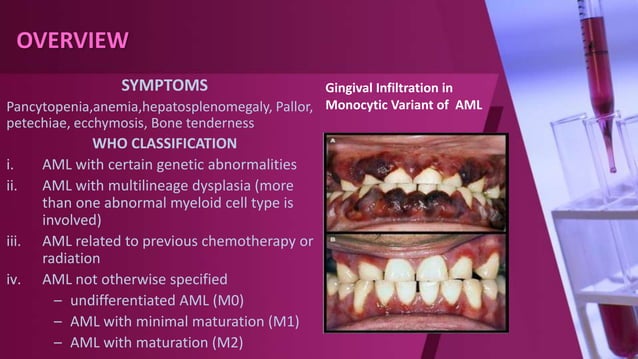 ACUTE MYELOID LEUKEMIA SIGNALLING | PPT