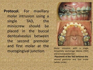 The use of temporary anchorage devices for molar intrusion | PPT