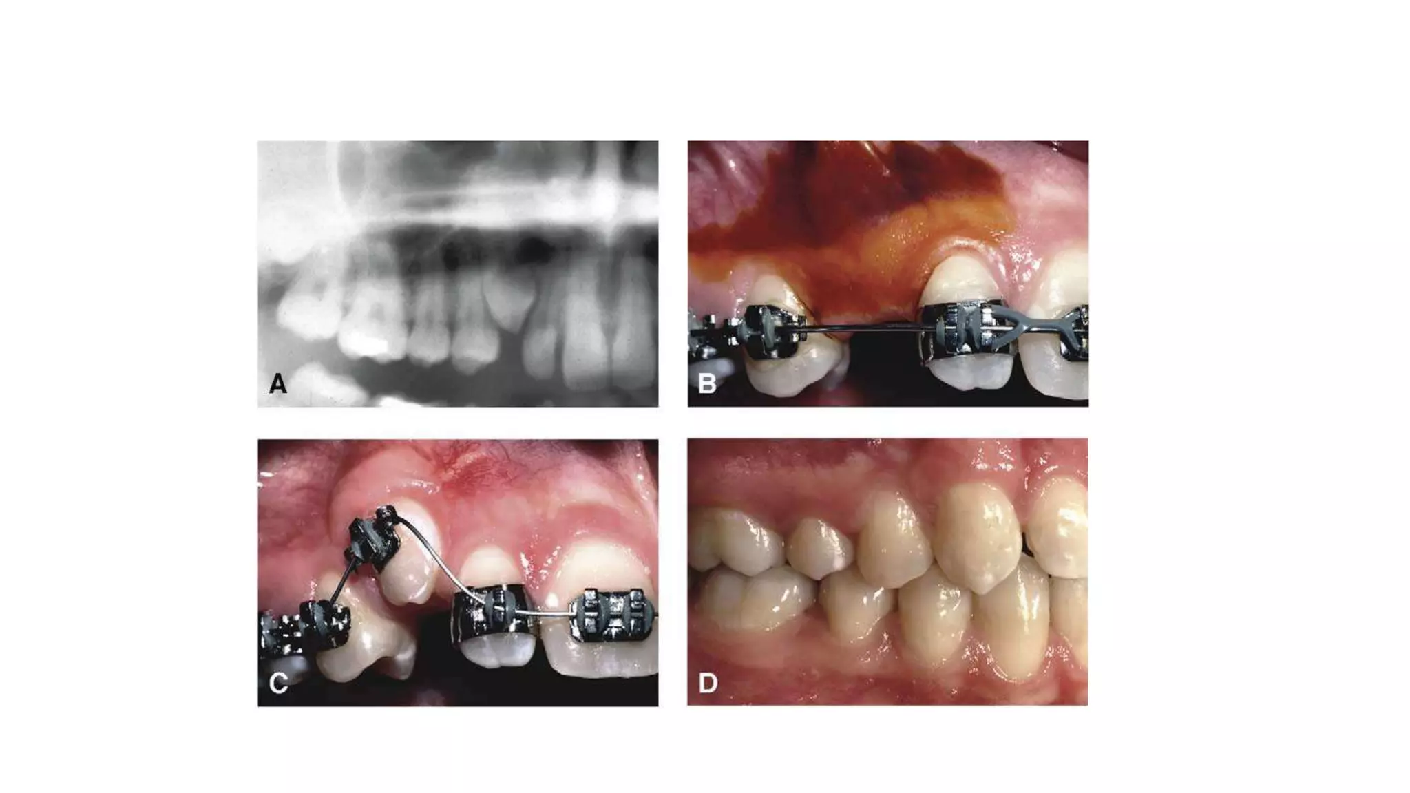surgical and orthodontic management of impacted maxillary caninespart 1 ...